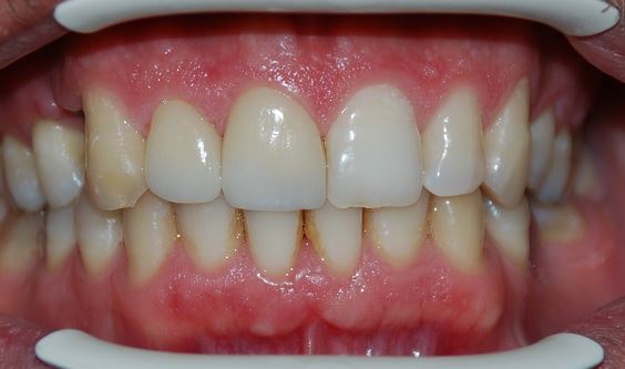 Empress / e.max press